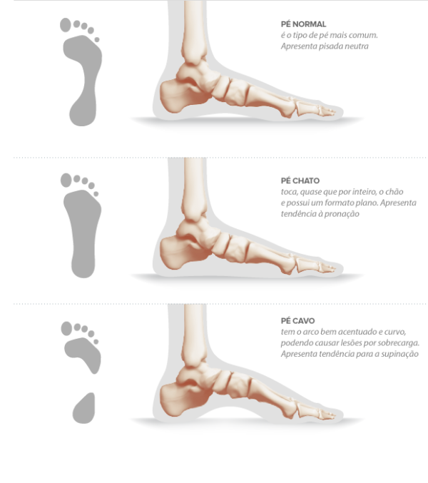 Fascite Plantar: o que é e como tratar - Kinex Fisioterapia